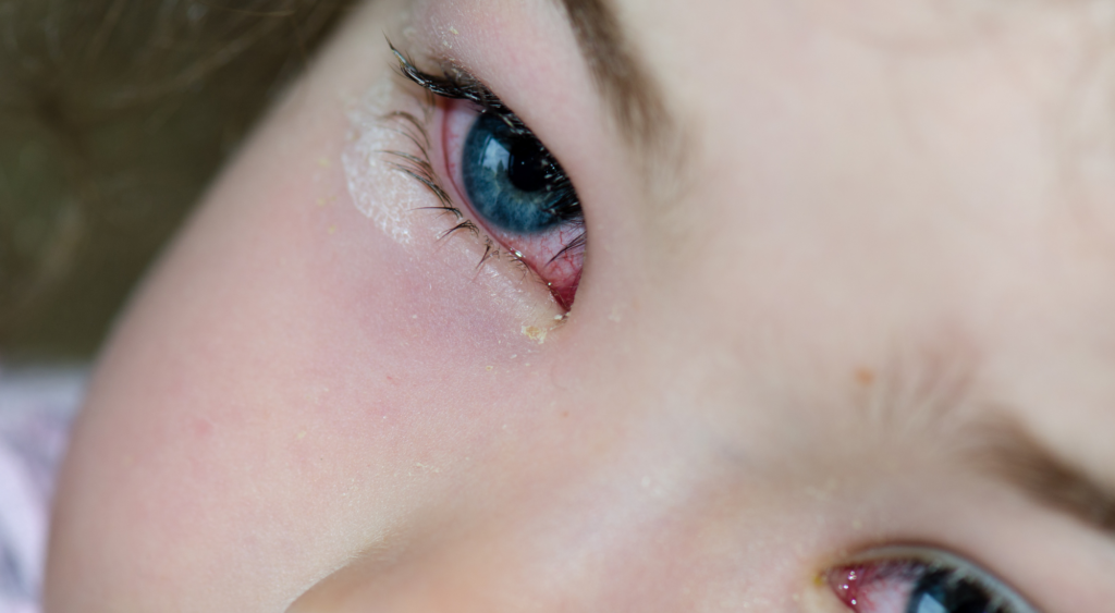 La kératoconjonctivite de l'enfant - Section œil